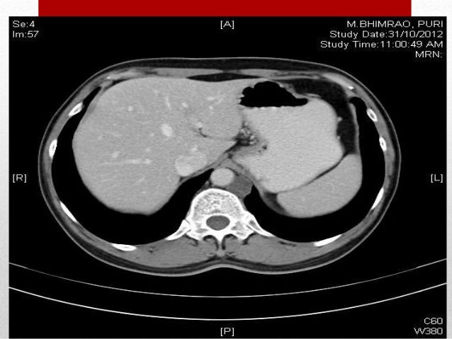 Retroperitoneal lymph node dissection kaushal