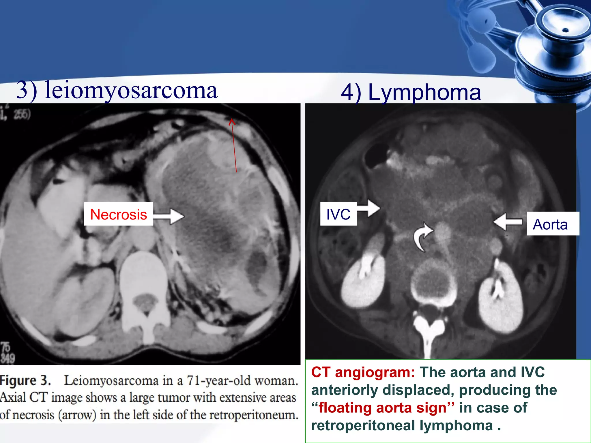 Retroperitoneal mass | PPT