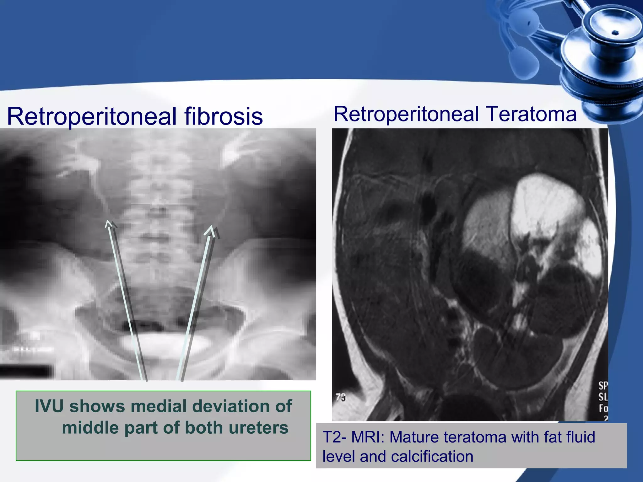 Retroperitoneal mass | PPT