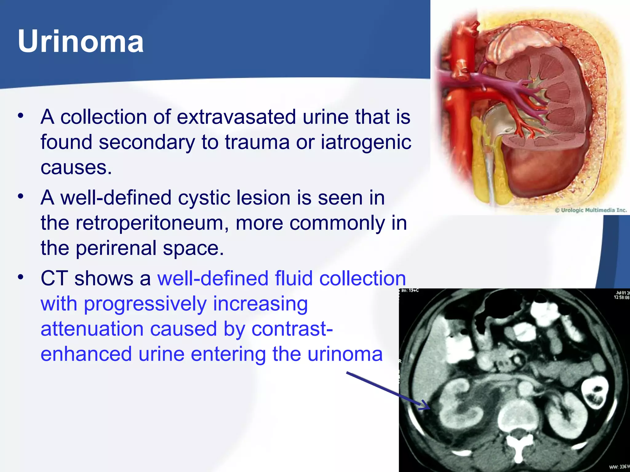 Retroperitoneal mass | PPT