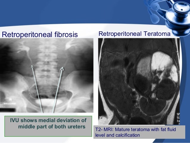 Retroperitoneal mass