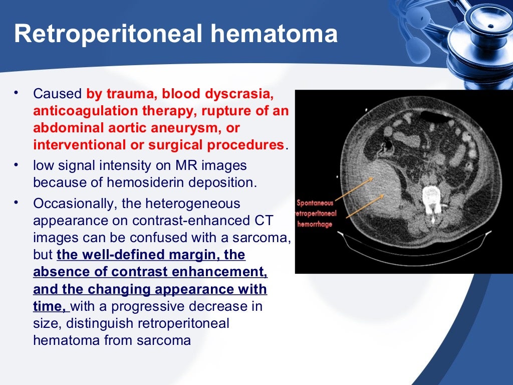 Retroperitoneal mass