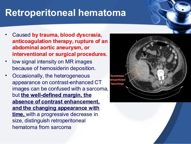 Retroperitoneal mass