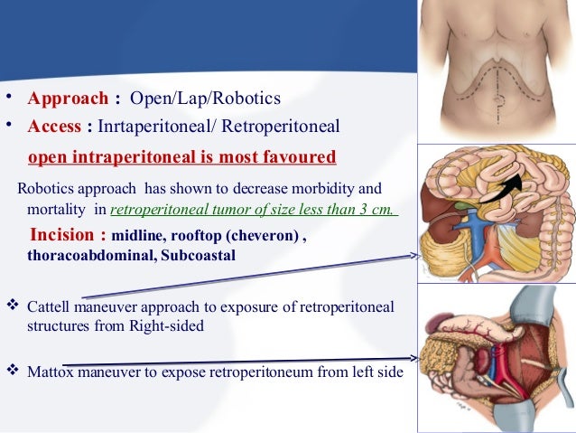 Retroperitoneal mass