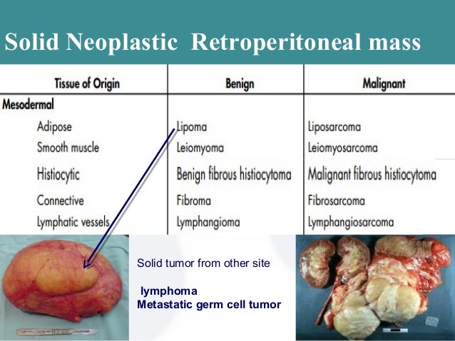 Retroperitoneal mass