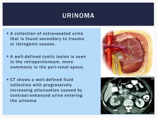 Retroperitoneal mass | PPTX