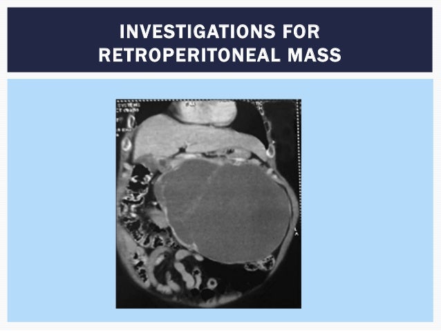 Retroperitoneal mass