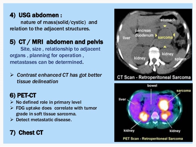 Retroperitoneal mass