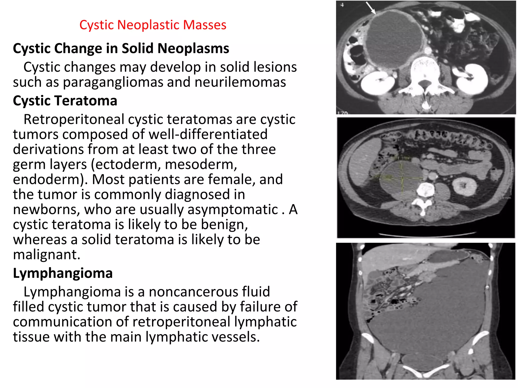 Retroperitoneal mass.pptx | Brain and Nervous System Disorders ...