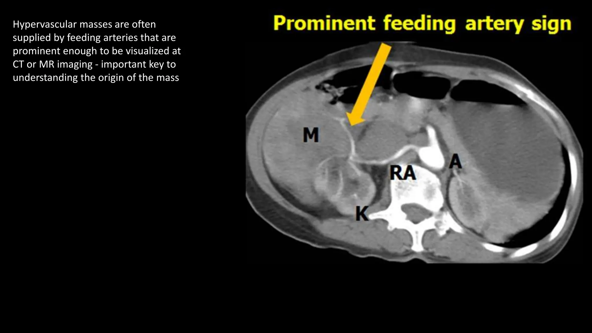 retroperitoneal mass and retroperitoneal anatomy | PPTX | Blood ...