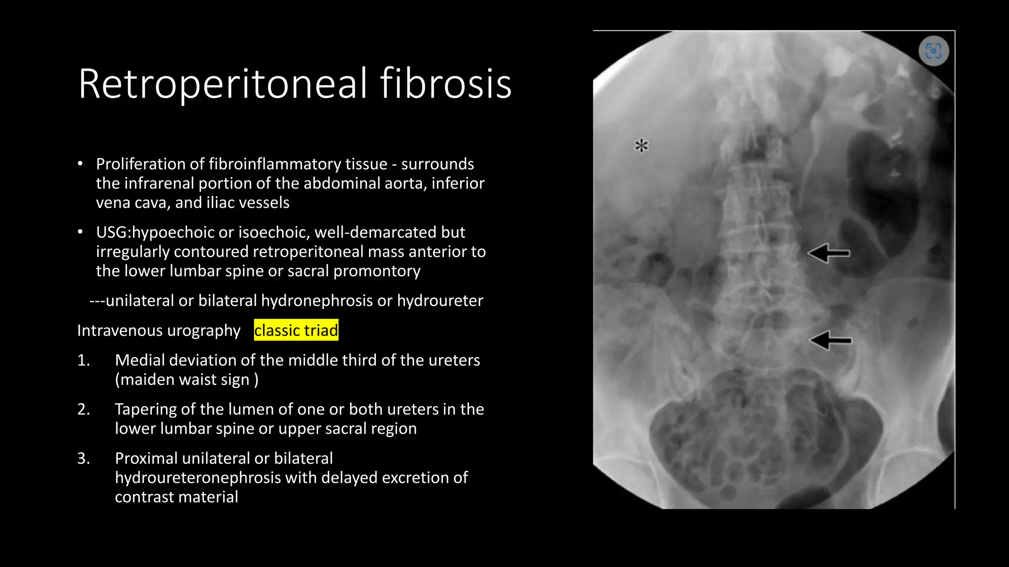 retroperitoneal mass and retroperitoneal anatomy | PPTX