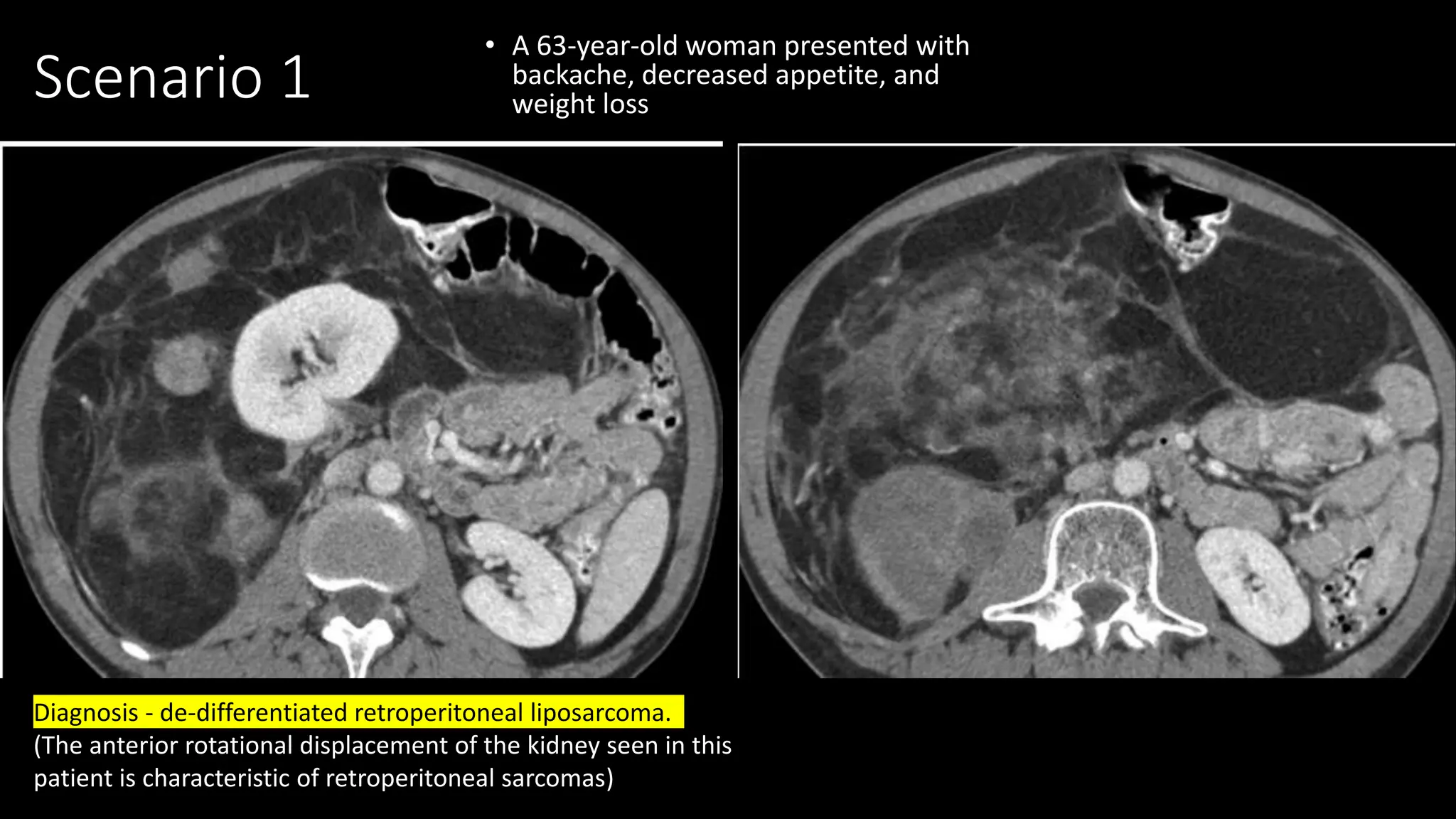 retroperitoneal mass and retroperitoneal anatomy | PPTX