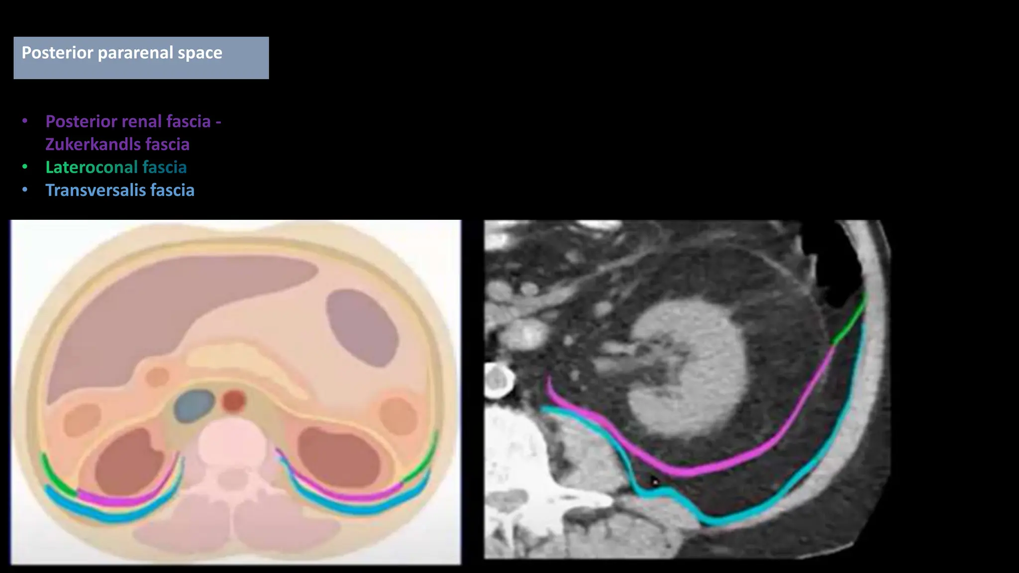 retroperitoneal mass and retroperitoneal anatomy | PPTX