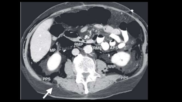 retroperitoneal mass and retroperitoneal anatomy | PPTX | Blood ...