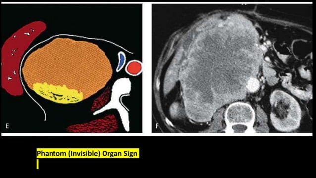 retroperitoneal mass and retroperitoneal anatomy | PPTX | Blood ...