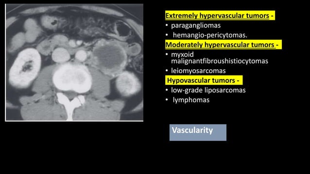 retroperitoneal mass and retroperitoneal anatomy | PPTX | Blood ...