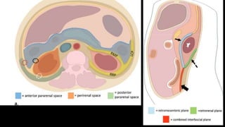 retroperitoneal mass and retroperitoneal anatomy | PPTX | Blood ...