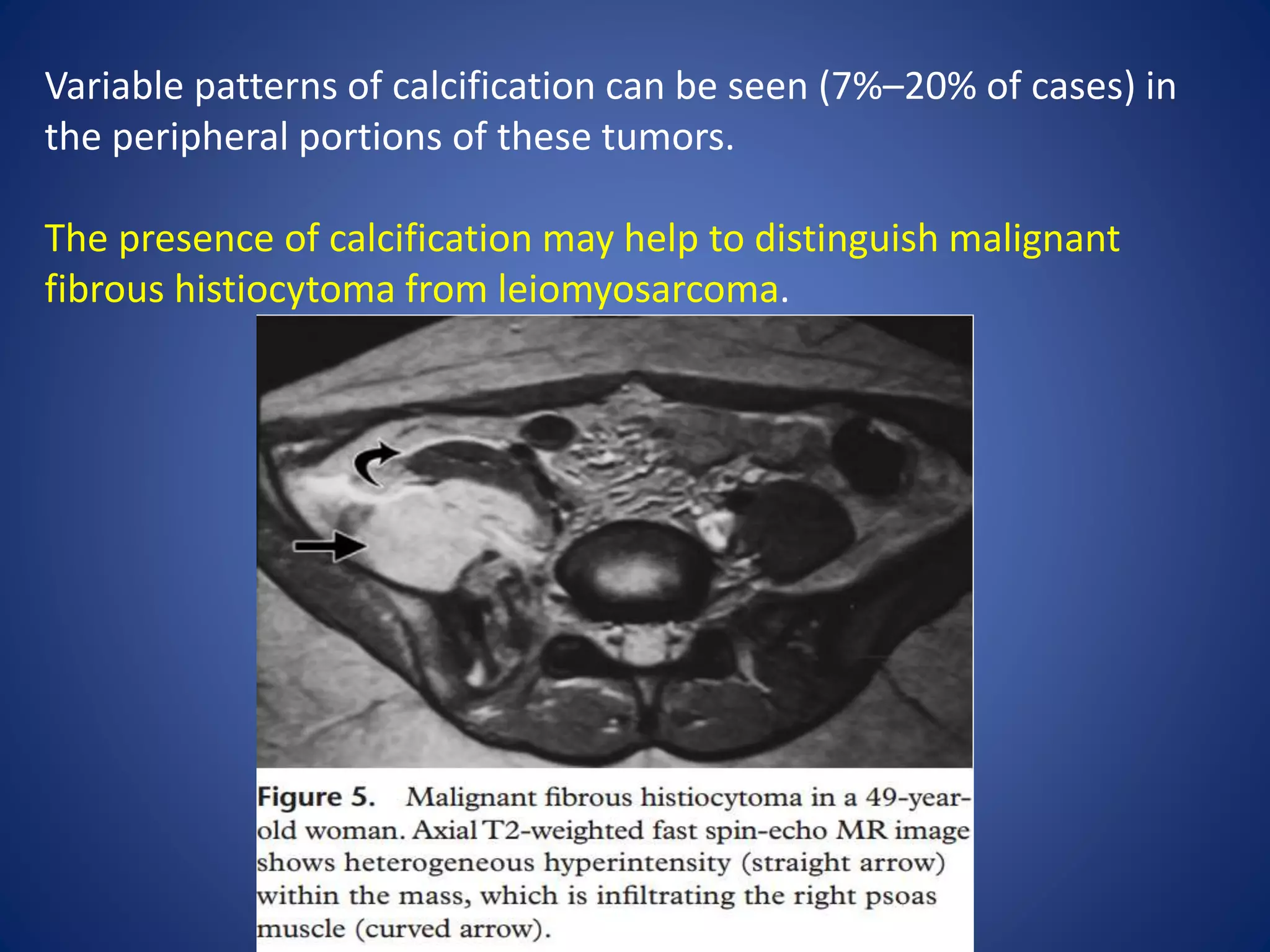 Retroperitoneal masses radiology | PPTX