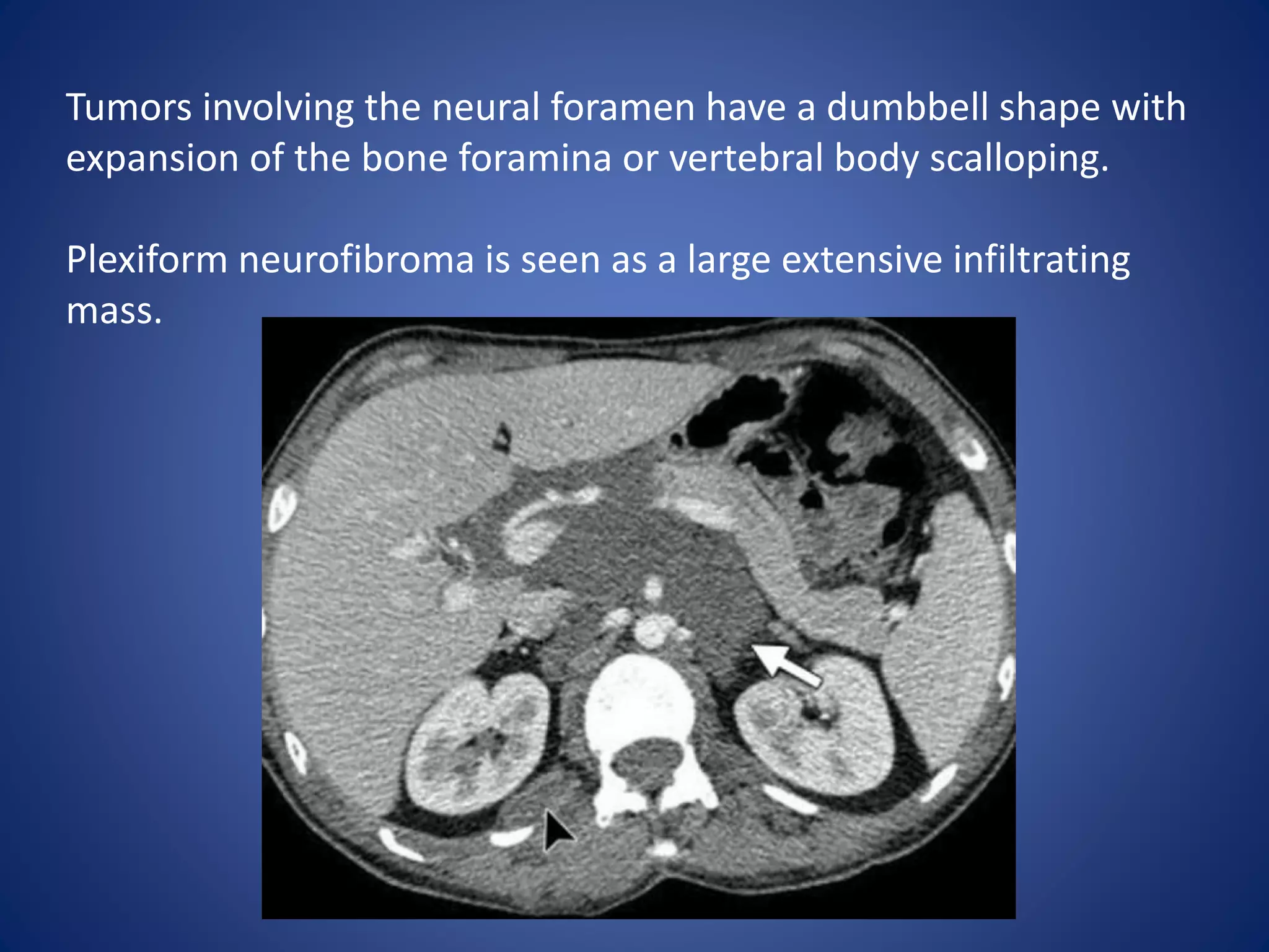 Retroperitoneal masses radiology | PPTX
