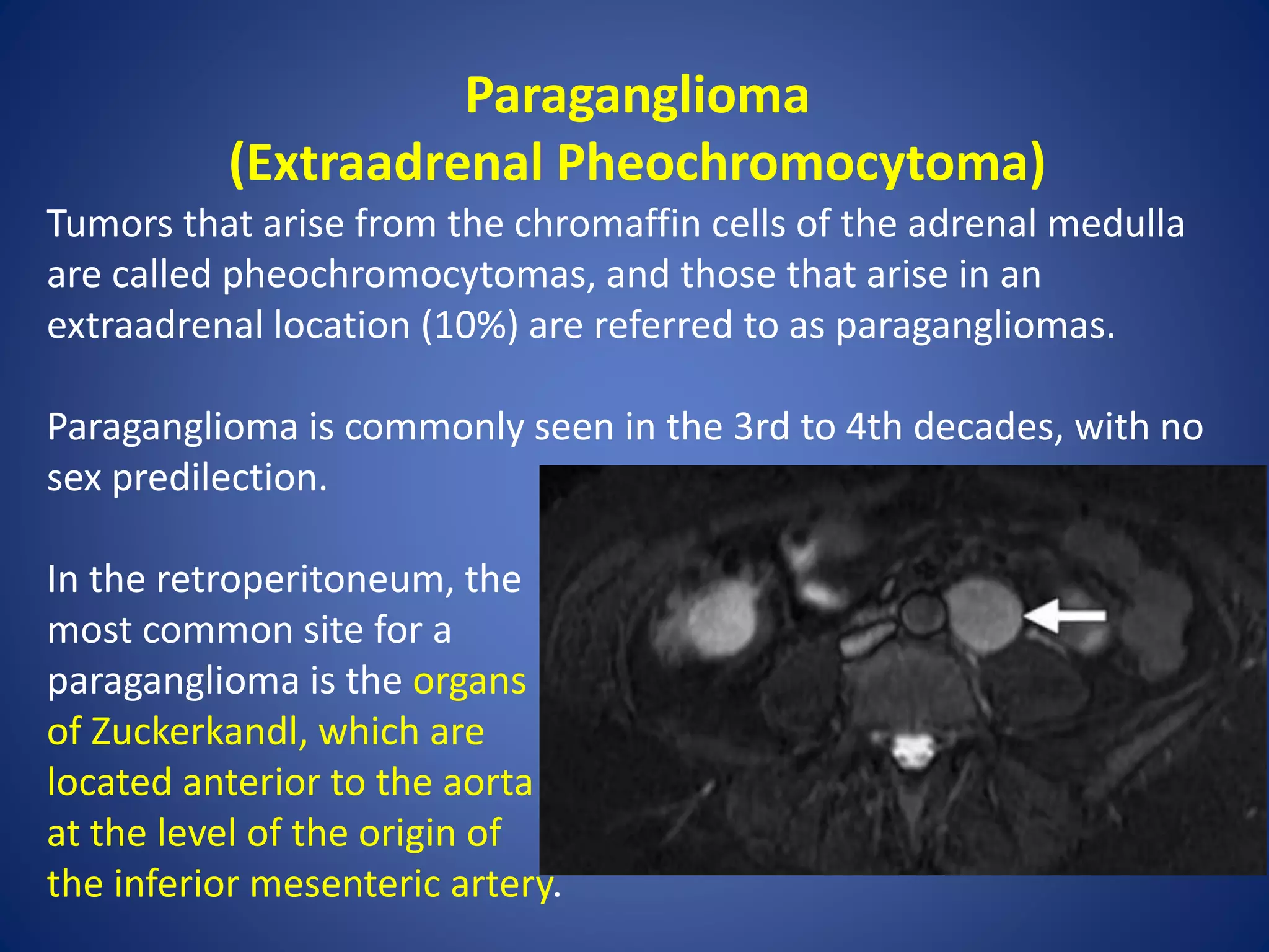 Retroperitoneal masses radiology | PPTX