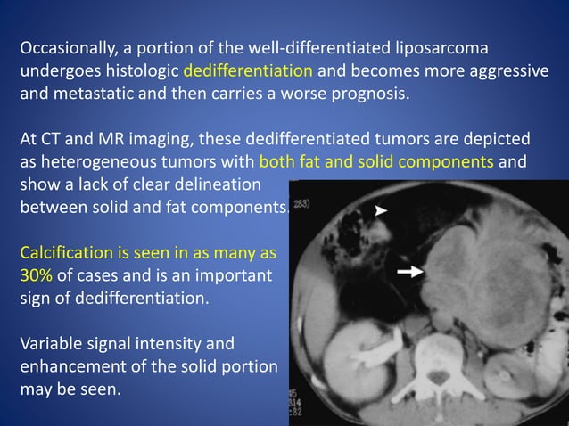 Retroperitoneal masses radiology | PPTX | Cancer | Diseases and Conditions