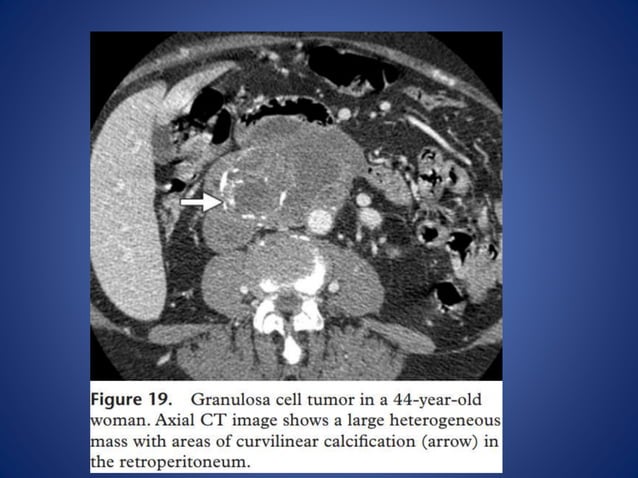 Retroperitoneal masses radiology | PPTX | Cancer | Diseases and Conditions