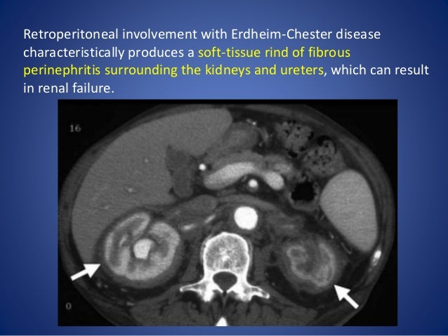 Retroperitoneal masses radiology