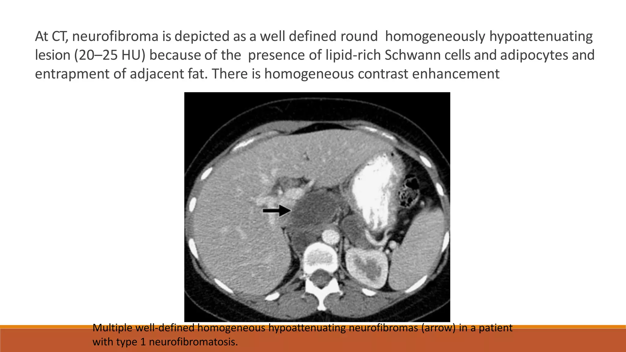 retroperitoneal masses.pptx