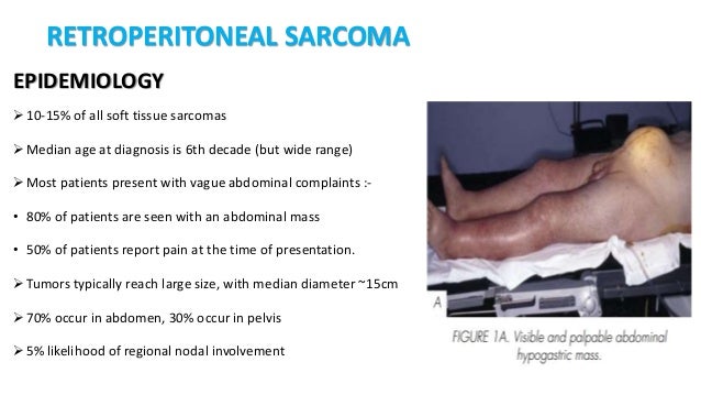 Retroperitoneal sarcoma