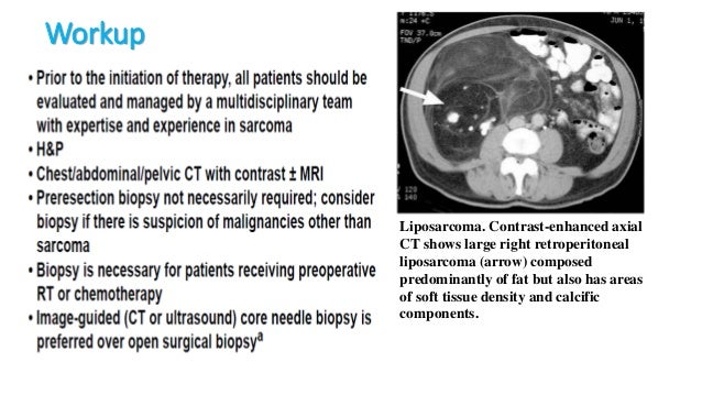 Retroperitoneal sarcoma