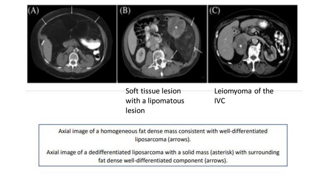 retroperitoneal tumors by ASM Minds Team .pdf