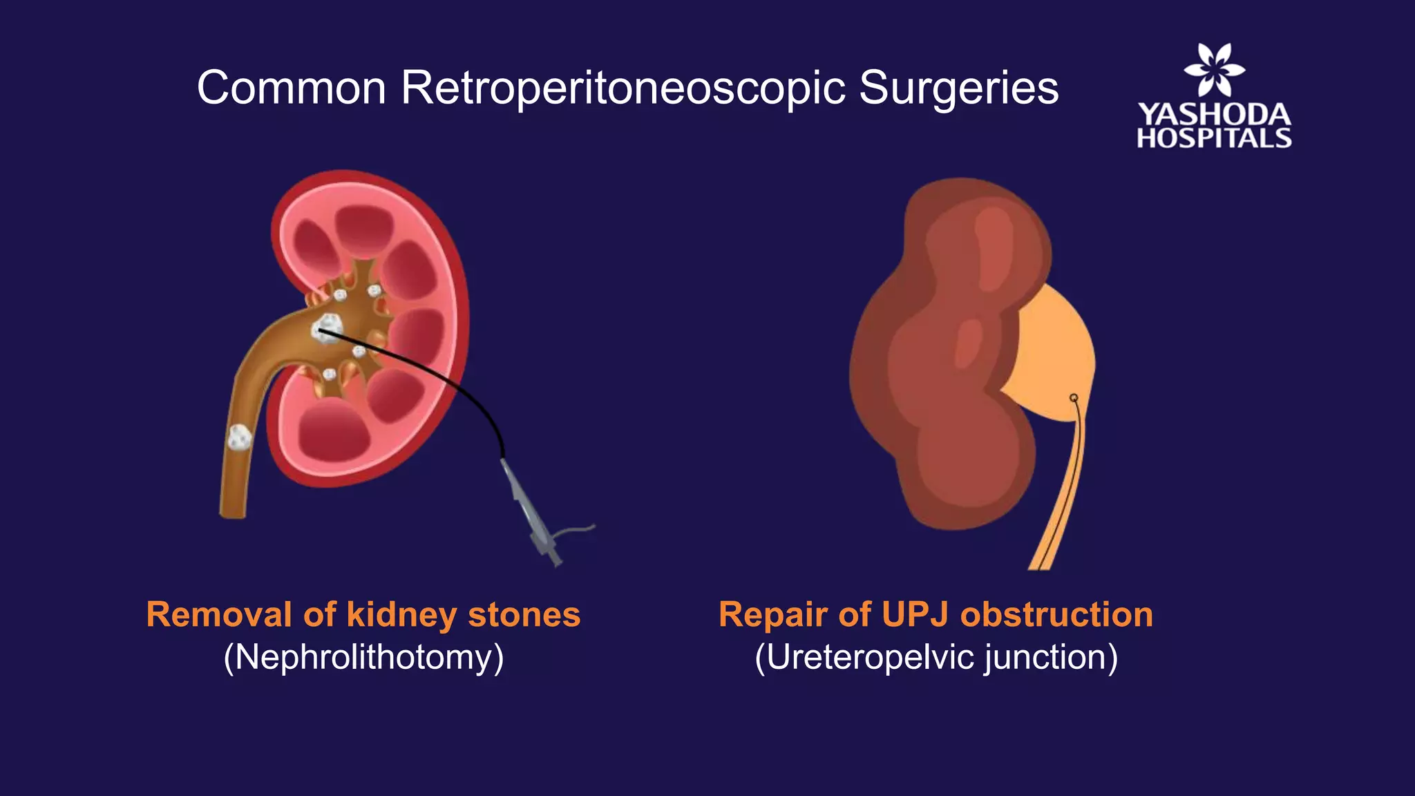 What is Retroperitoneoscopic Surgery | PPTX