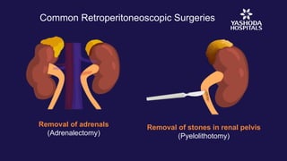 What is Retroperitoneoscopic Surgery | PPT