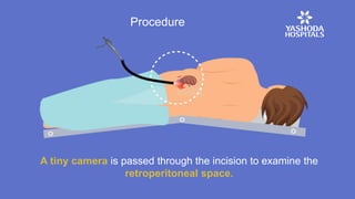 What is Retroperitoneoscopic Surgery | PPT
