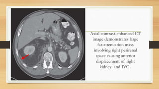 Retroperitoneum | PPTX