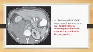 Retroperitoneum | PPTX