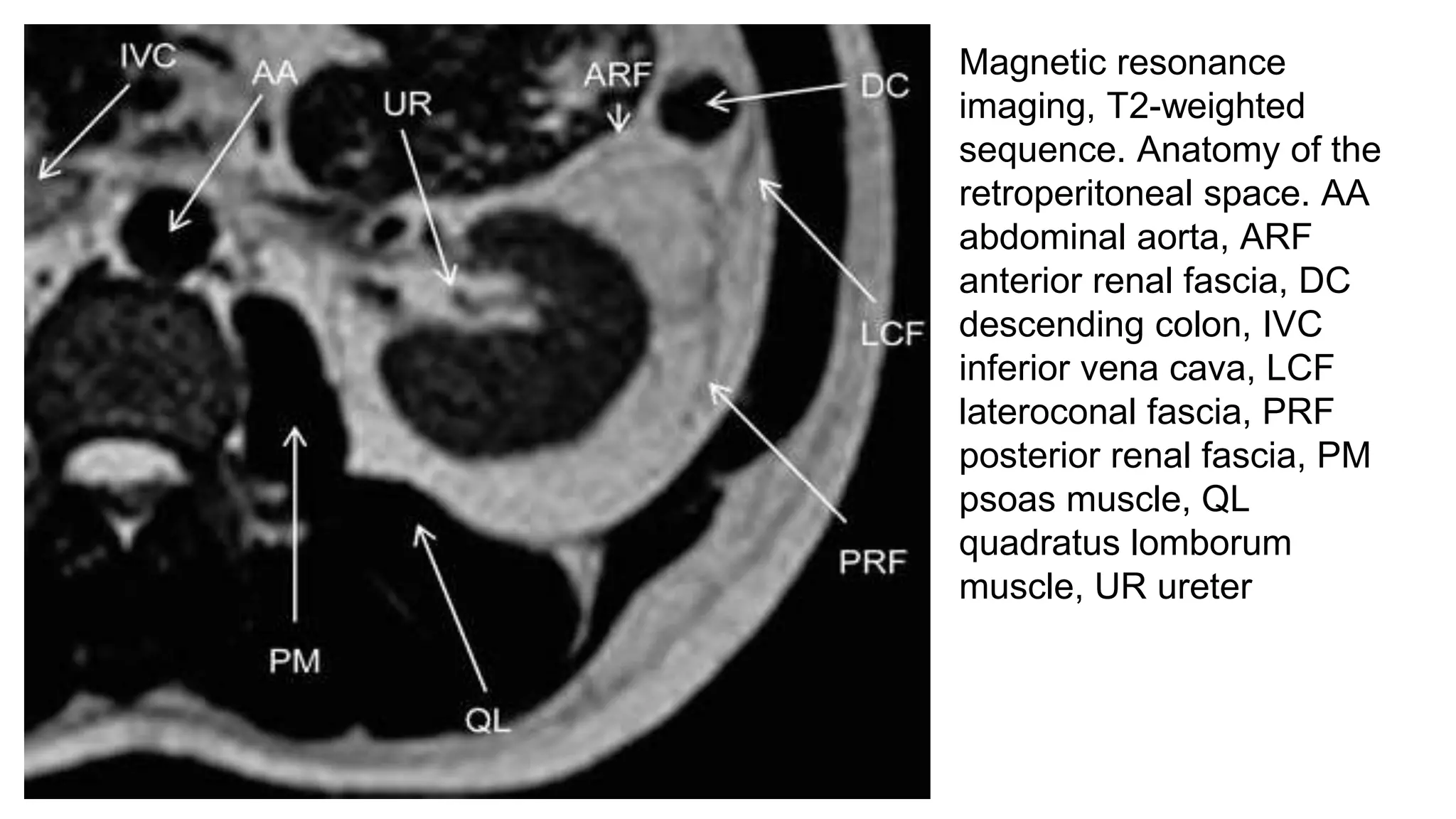Anatomy of Retroperitoneum. | PPTX