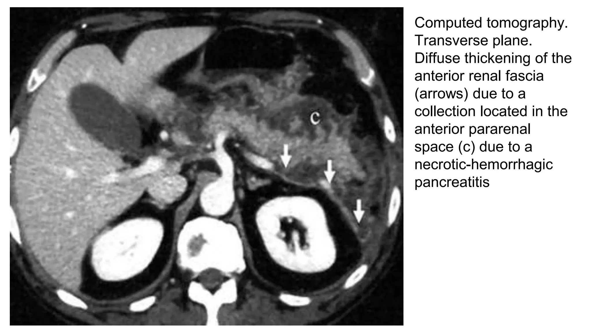 Anatomy of Retroperitoneum. | PPTX