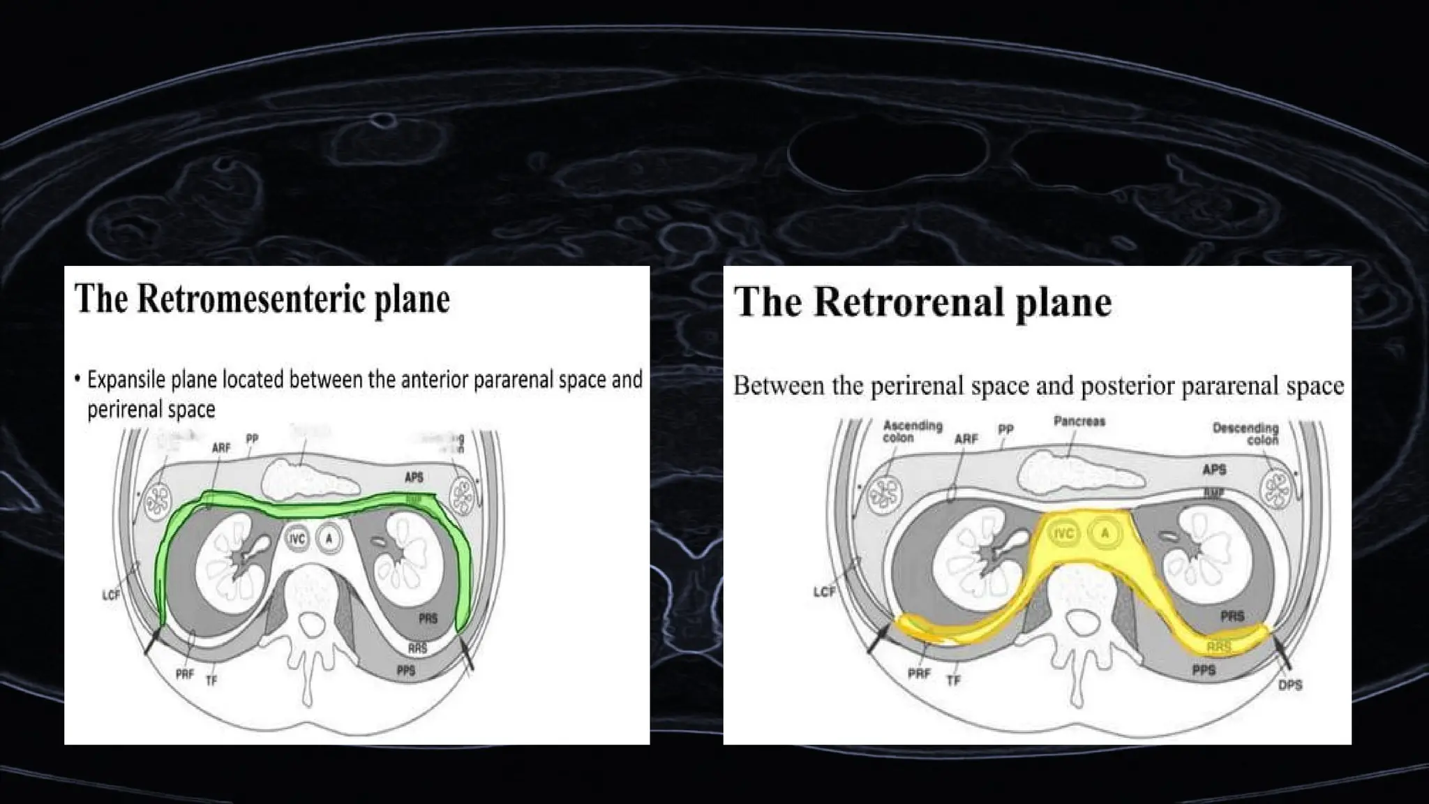 Retroperitoneum anatomy by Dr. A.Sabith Meeran , MD Radiodiagnosis | PPTX