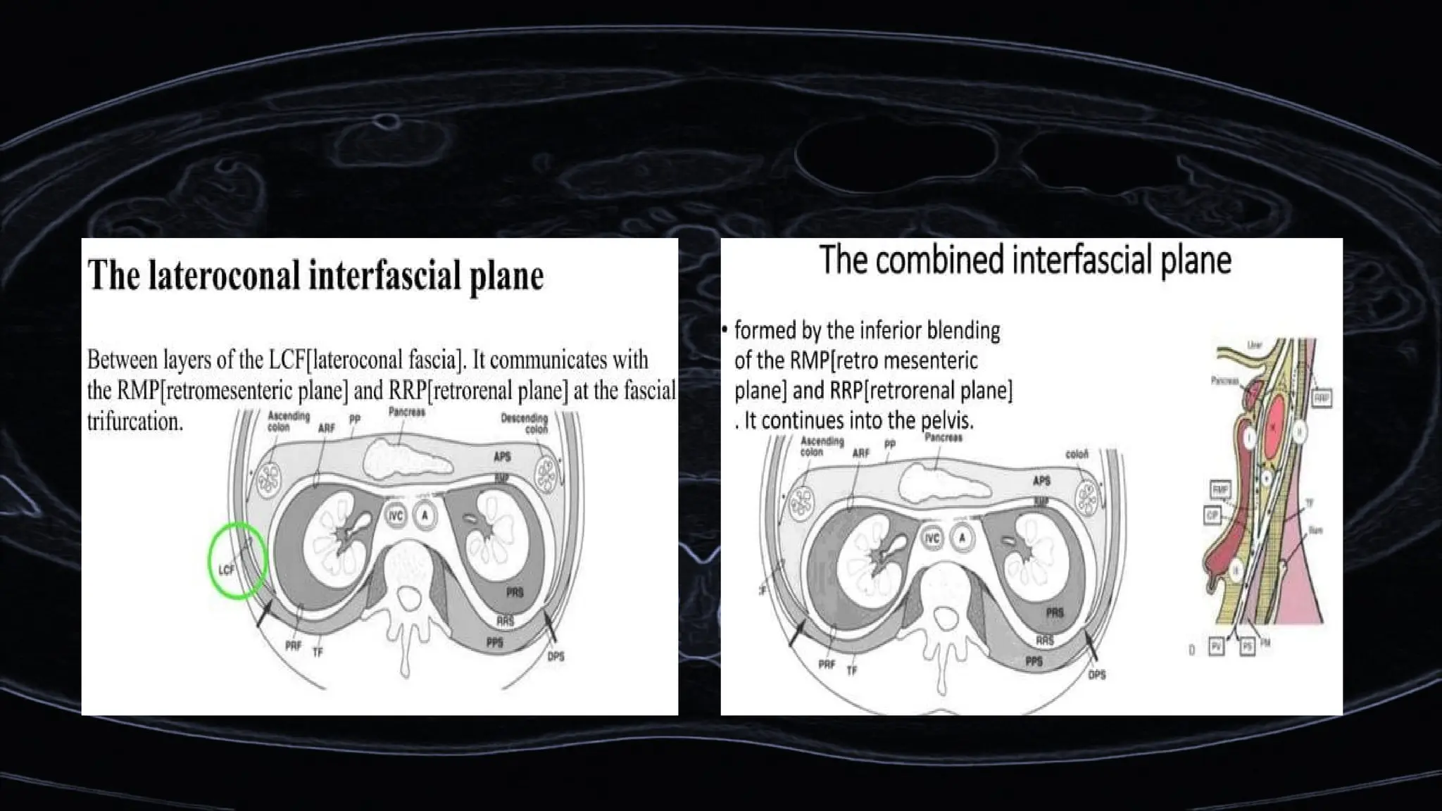 Retroperitoneum anatomy by Dr. A.Sabith Meeran , MD Radiodiagnosis | PPTX