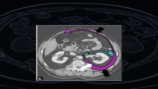 Retroperitoneum anatomy by Dr. A.Sabith Meeran , MD Radiodiagnosis | PPTX