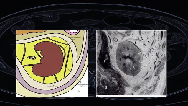 Retroperitoneum anatomy by Dr. A.Sabith Meeran , MD Radiodiagnosis | PPTX