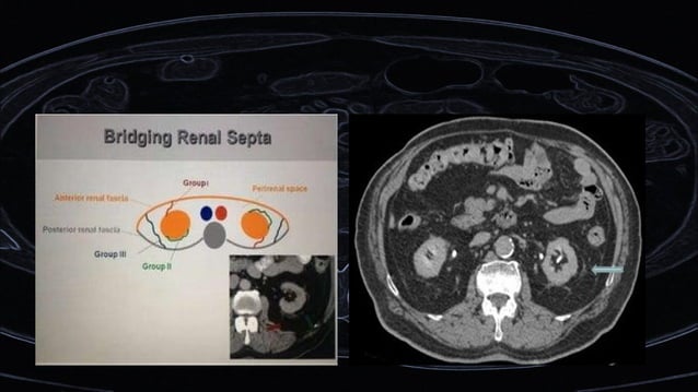 Retroperitoneum anatomy by Dr. A.Sabith Meeran , MD Radiodiagnosis | PPTX