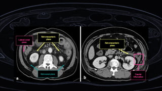 Retroperitoneum anatomy by Dr. A.Sabith Meeran , MD Radiodiagnosis | PPTX