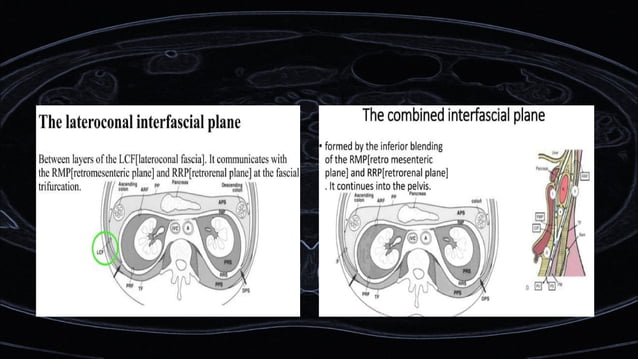 Retroperitoneum anatomy by Dr. A.Sabith Meeran , MD Radiodiagnosis | PPTX