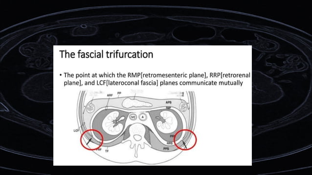 Retroperitoneum anatomy by Dr. A.Sabith Meeran , MD Radiodiagnosis | PPTX