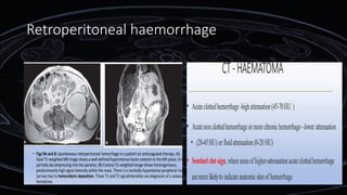 Retroperitoneum anatomy by Dr. A.Sabith Meeran , MD Radiodiagnosis | PPTX