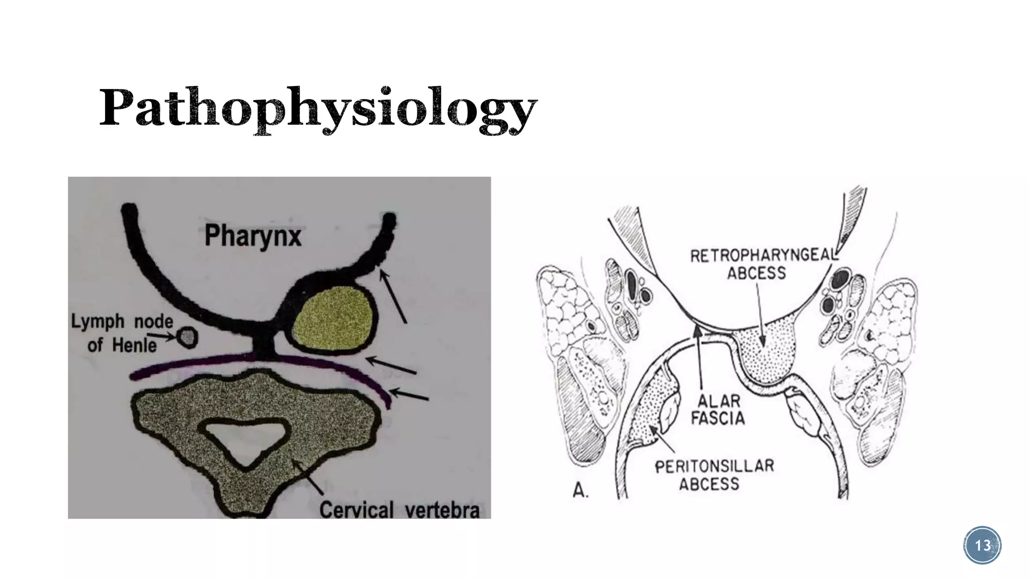 Retropharyngeal Abscess by Boluwatife Afolabi | PPTX