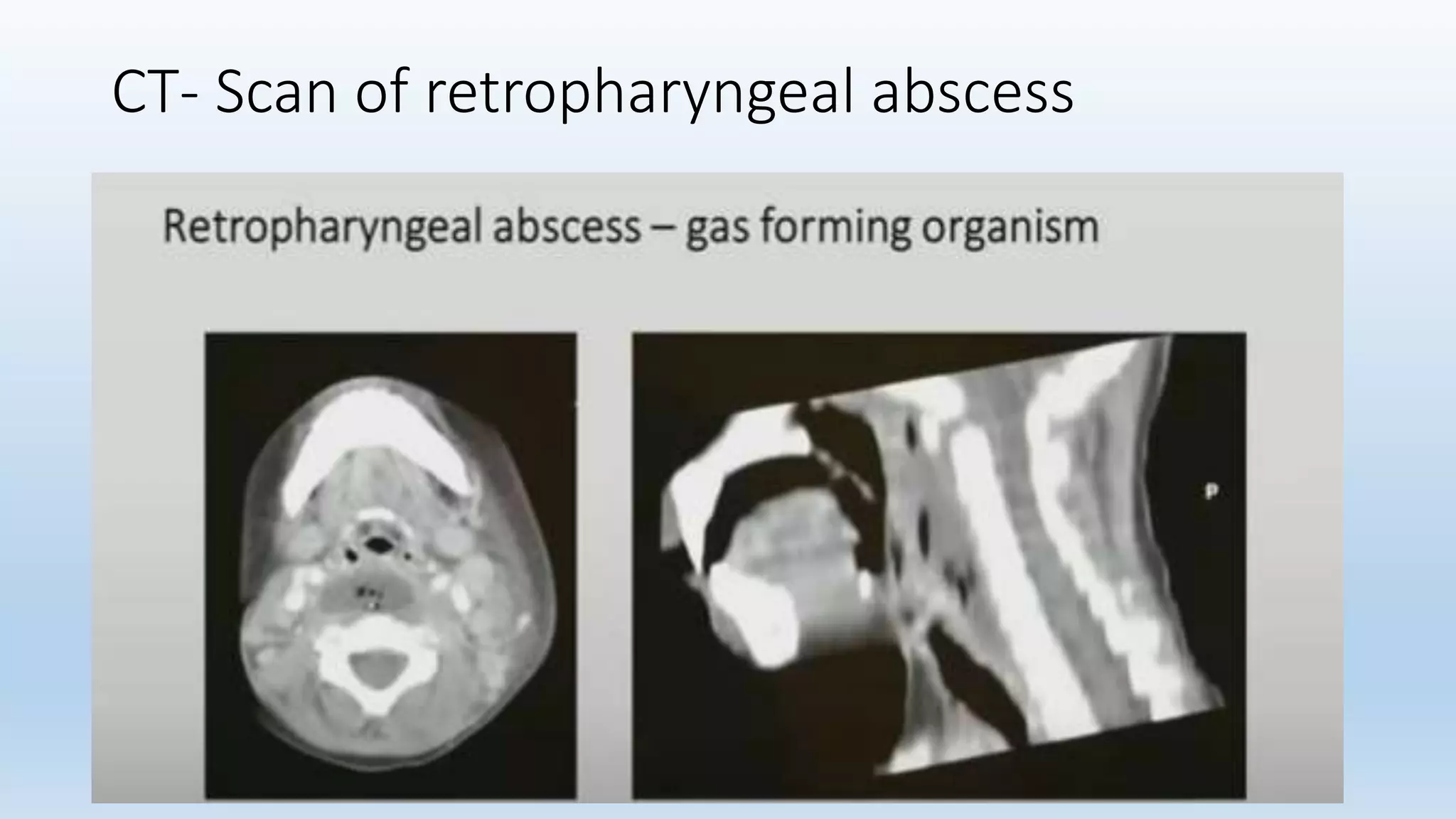 Retropharyngeal space | PPTX
