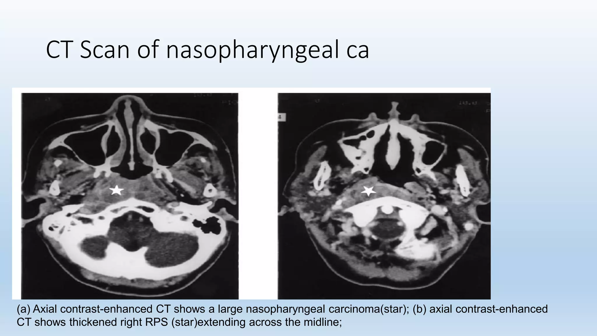 Retropharyngeal space | PPTX